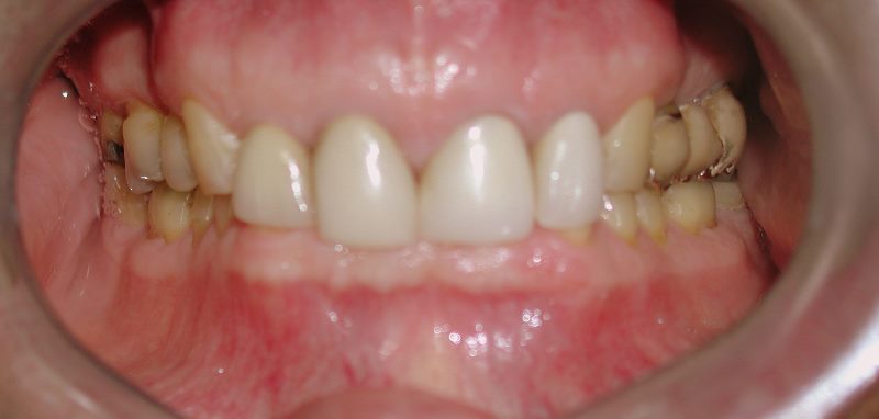 PROTESIS TOTAL: REHABILITACION PROTESIS TOTAL