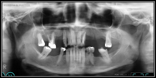 Odonto Blog: Abrasão