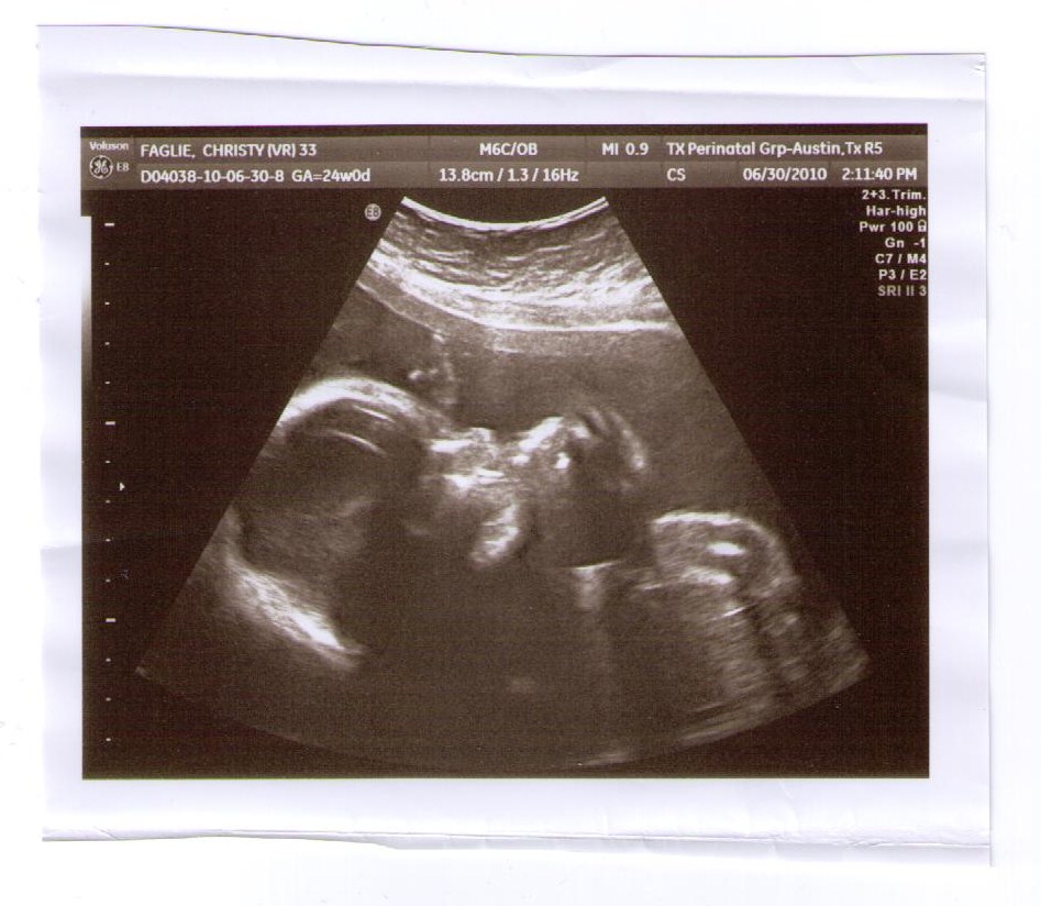 One Day At A Time: Baby Girl ultrasound 24 weeks