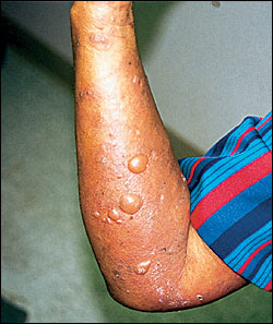 The Pulse: Bullous Pemphigoid