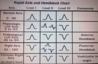 12 Lead EKG: Rapid Axis Chart Hemiblock chart