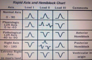 12 Lead EKG: Rapid Axis Chart Hemiblock chart