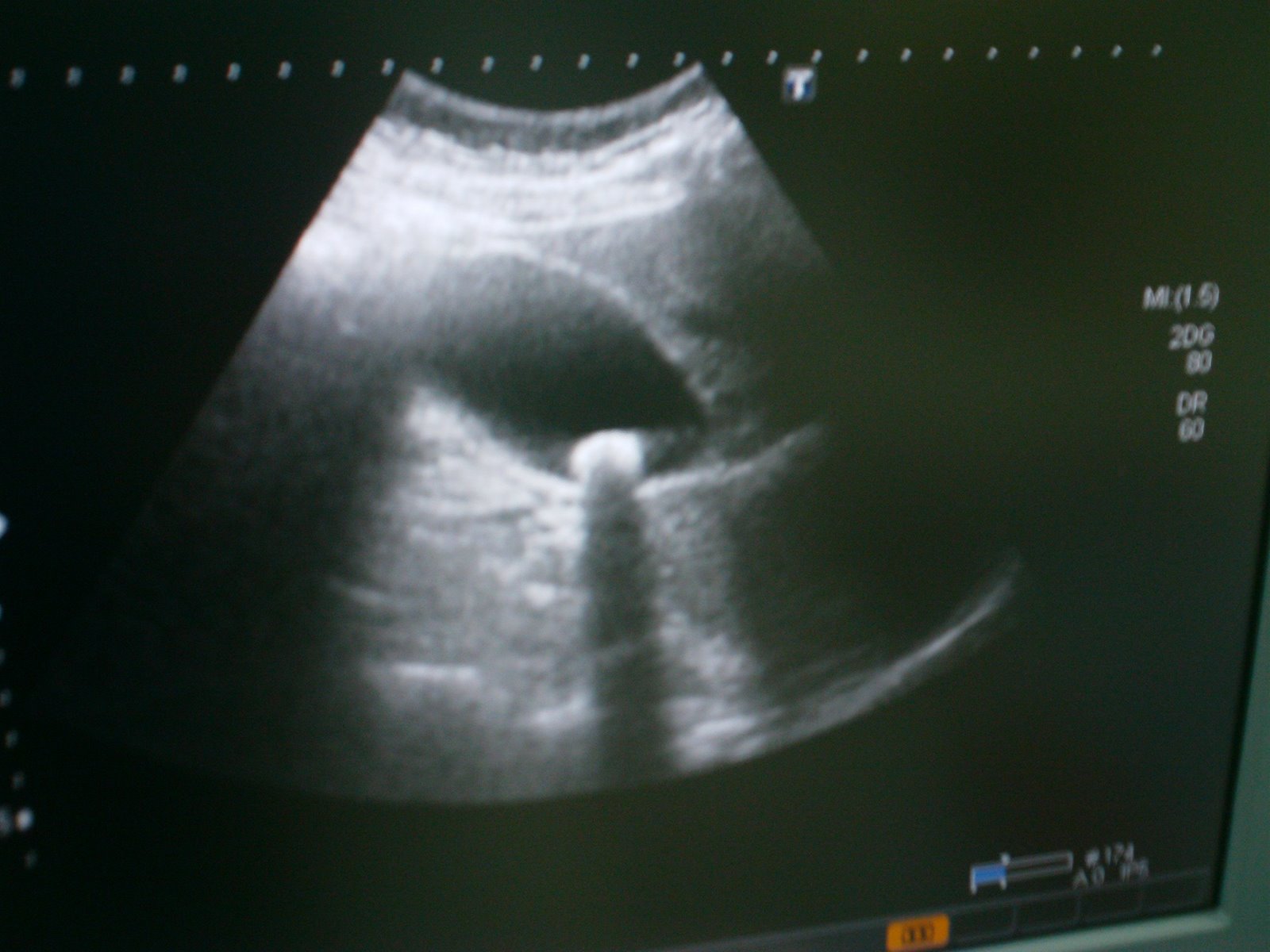 DR. GUSTAVO ESPINOSA: COLELITIASIS