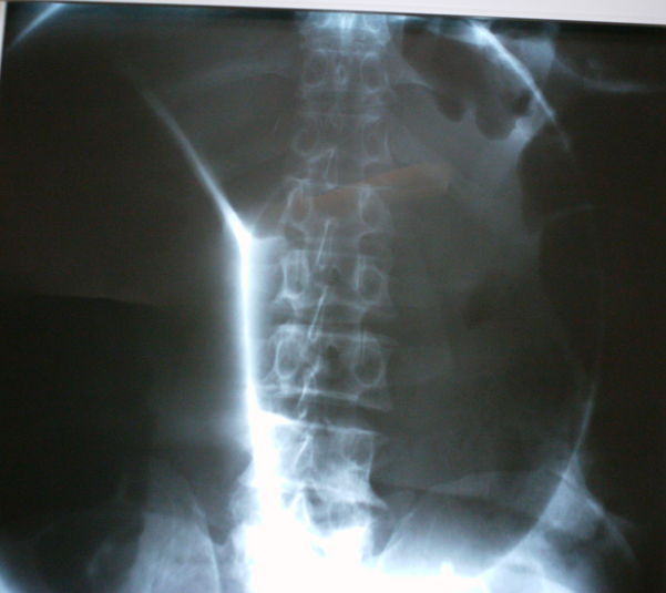 DR. GUSTAVO ESPINOSA: VOLVULO DEL SIGMOIDES