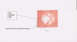 GLAUCOMA...EARLY DETECTION: The Shadow Sign