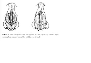 Shield Graft: The mystery of all the different types of nose grafts