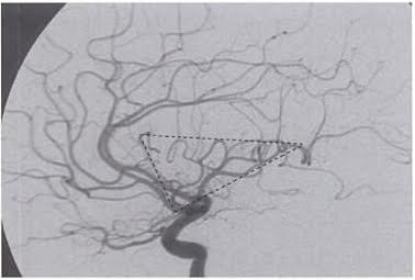 Dr.Sharath's Blog: Sylvian triangle (Angiographic)