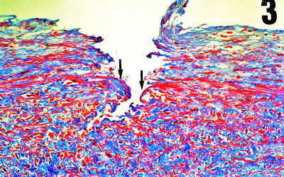 HISTOPATOLOGIA FORENSE PRACTICA (FORENSIC PATHOLOGY FORUM): 6.-SIGNS IN ...