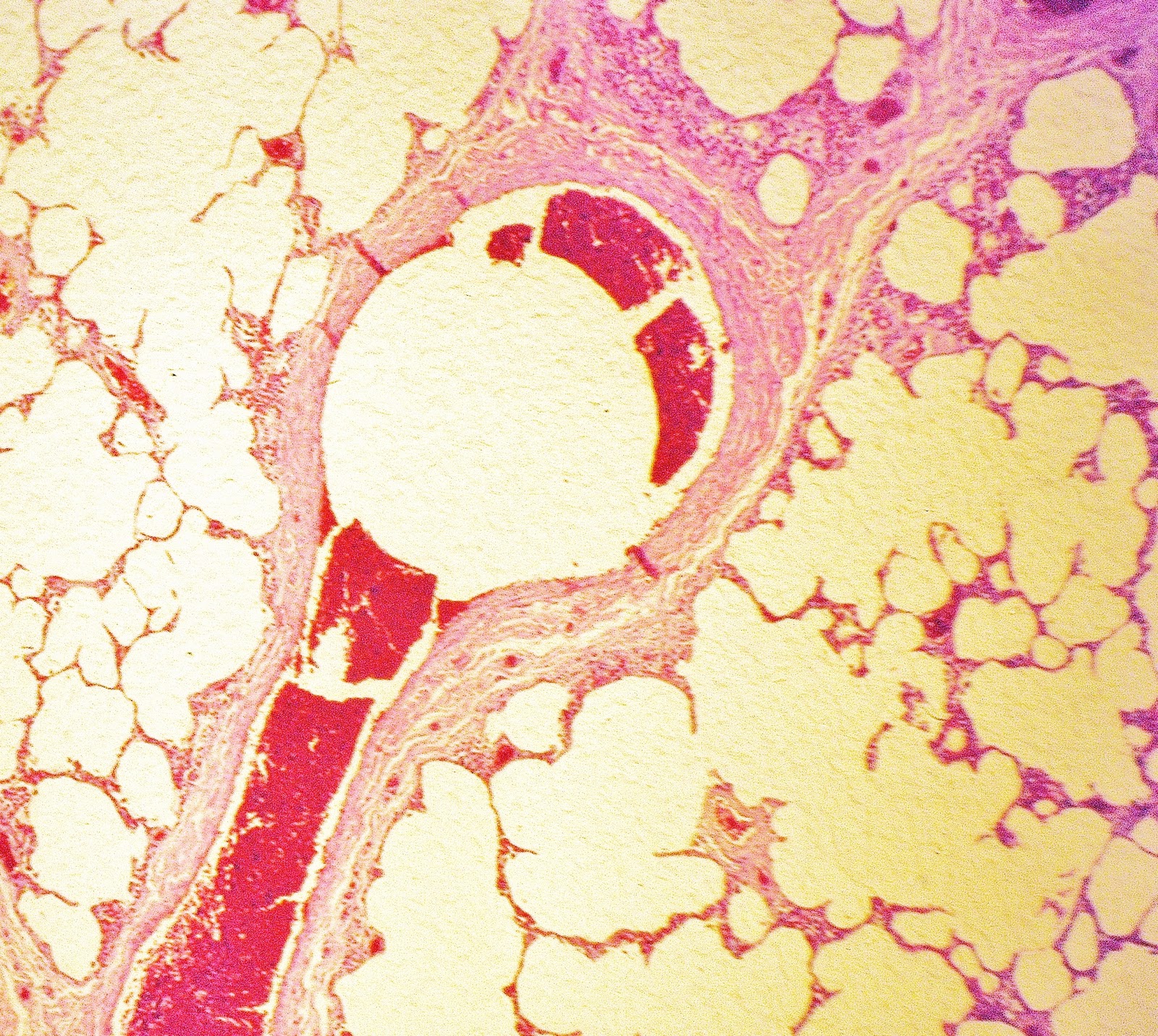 ForensicPathologyForum (HISTOPATOLOGÍA FORENSE PRÁCTICA): 3.-AIR ...
