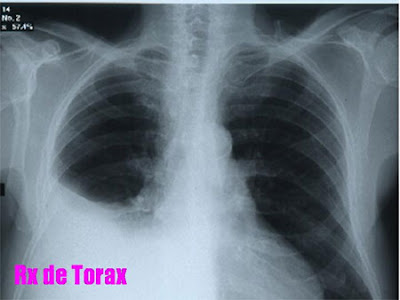 Boas Práticas Farmacêuticas: Tudo sobre Derrame Pleural