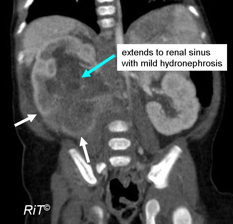 Horseshoe Kidney Hydronephrosis at Peggy Bergmann blog