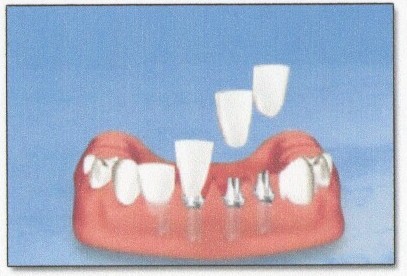 Aashirwad Dental Implant Center: Multiple Teeth Implants