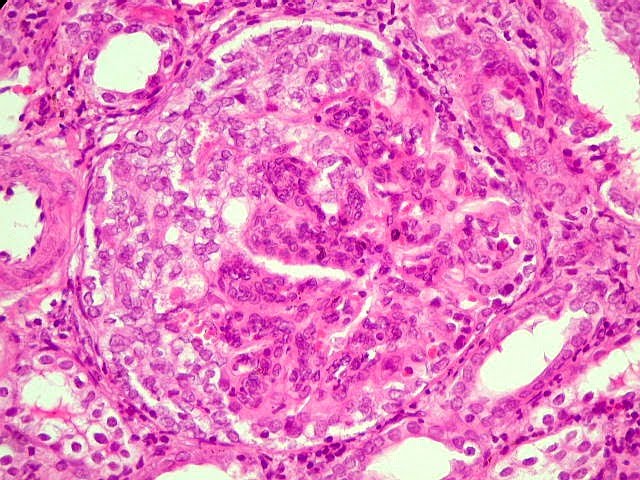 De olho na patologia.: Gromerulonefrite