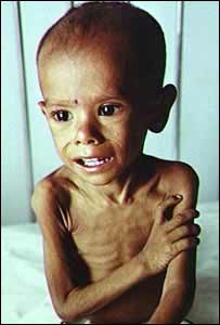 DESNUTRICIÓN INFANTIL: MARASMO