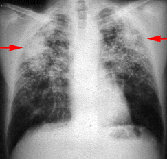 Patologia de Órgãos e Sistemas: PNEUMOCONIOSE