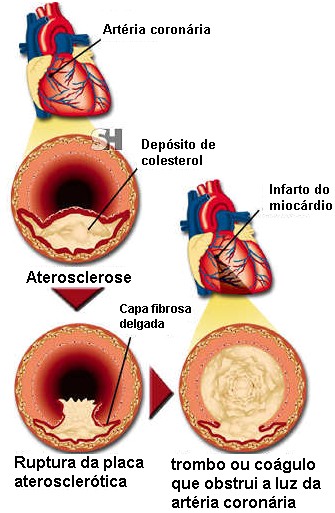 Enfermagem e Medicina: Aterosclerose