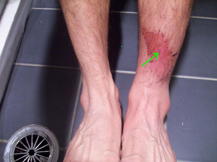 Gye Greene's Thoughts: Infected leg