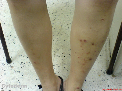 A Skin Blog: Dermatoses of Pregnancy