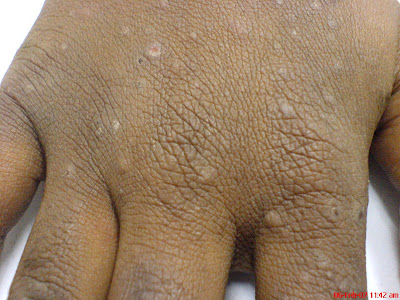 A Skin Blog: Papular eczema