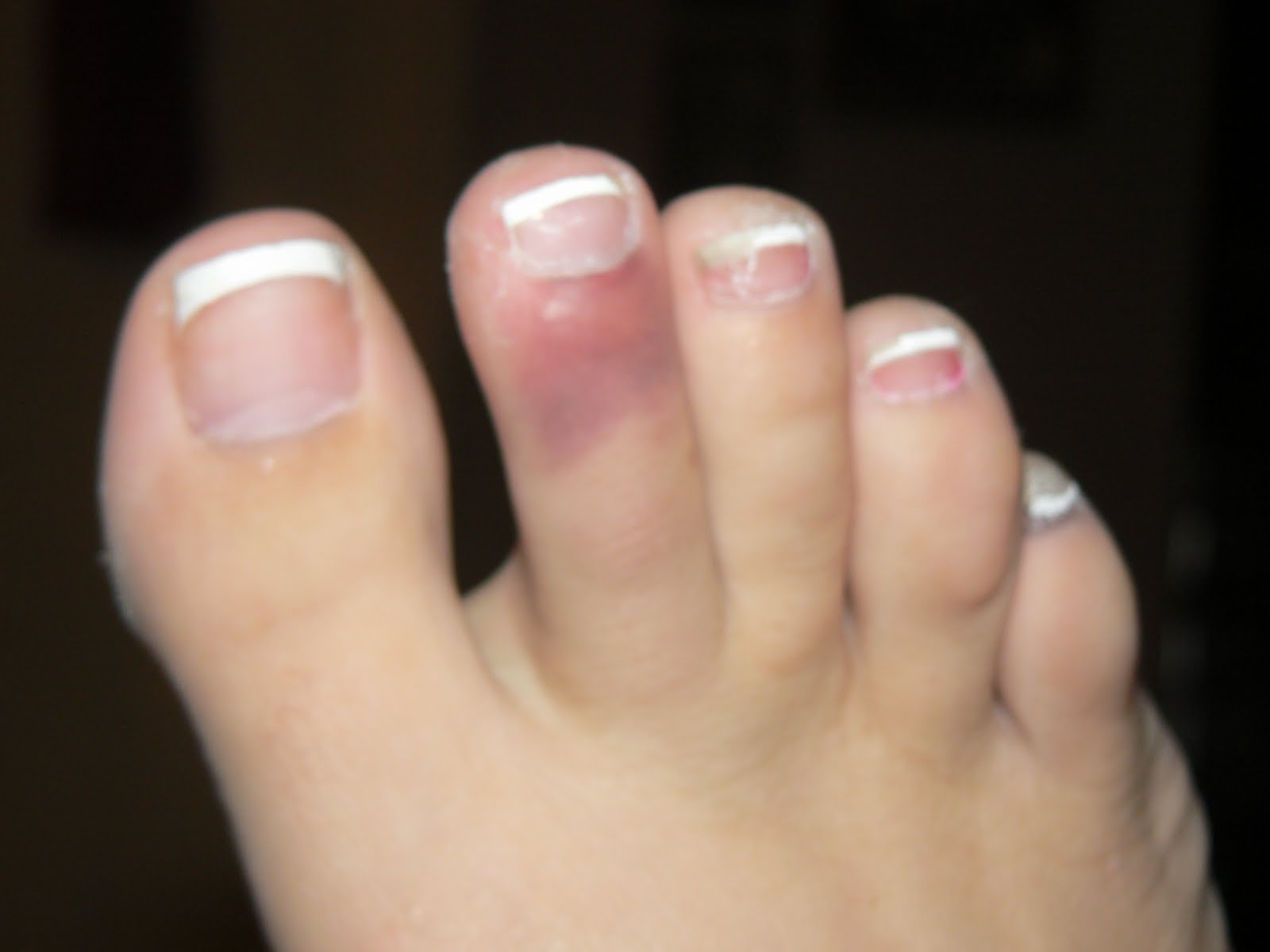 Life With Our Brown Eyed Girls: Broken Toe, Missing Teeth and Shut Your ...