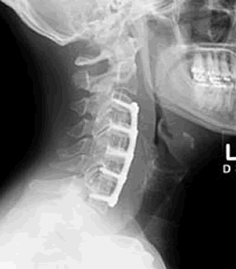 Radiologia - Raio x Coluna Cervical