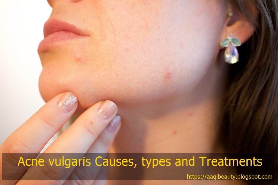 Acne vulgaris Causes, types and Treatments - Aaqi Beauty